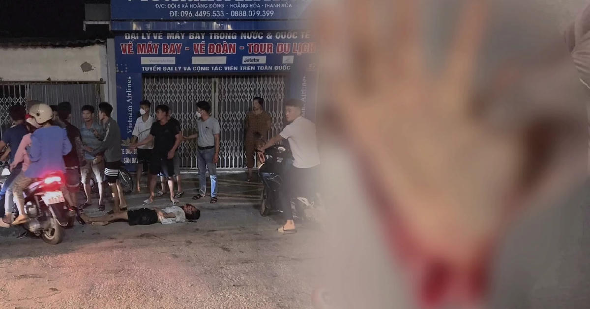 Bàn tay đứt lìa sau khi ngã xe máy